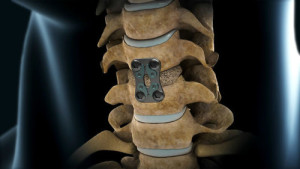Recovery after lumbar discectomy surgery: feeling, time, exercises