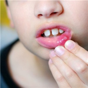 Blisters in Mouth: Causes & Treatment