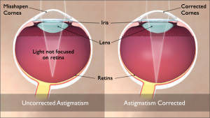 What Is Astigmatism and How to Fix It: Guides and Videos