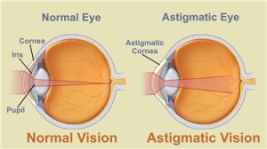 What Is Astigmatism and How to Fix It: Guides and Videos