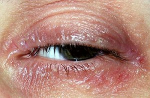 Eczema Around Eyes: Causes and Ways of Treatment | IYTmed.com