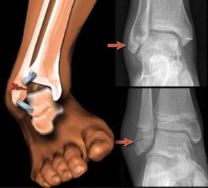 Inversion Ankle Sprains: How to Treat and Care | IYTmed.com