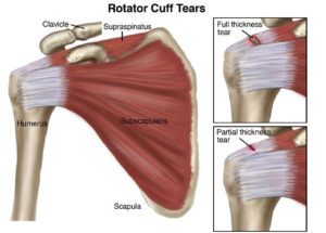 Why My Torn Rotator Cuff Hurts With a Lateral Arm Raise?