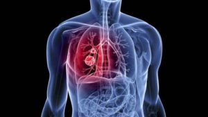 Heavy Breathing: Causes and Treatments | IYTmed.com