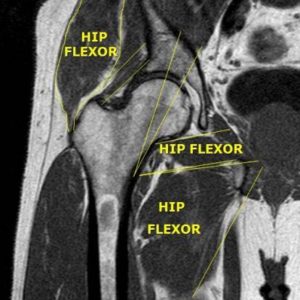 Hip Flexor Strain: Signs, Causes, Treatment and Recovery | IYTmed.com