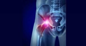 Hip Flexor Strain: Signs, Causes, Treatment and Recovery | IYTmed.com