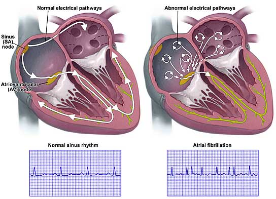 Paroxysmal Atrial Fibrillation Symptoms Causes And Treatment IYTmed