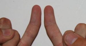 Crooked Little Finger: Causes and Remedies | IYTmed.com