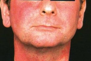 Red Flushing Face and Skin: Causes, Treatment and Prevention