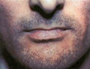 Upper Lip Twitching: Causes and Treatment
