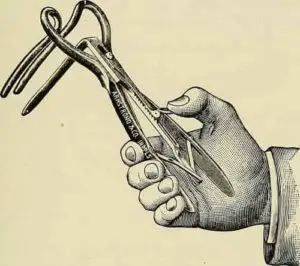 Treating an Impacted Colon | IYTmed.com