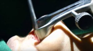 Deviated Septum Surgery Recovery Time | IYTmed.com