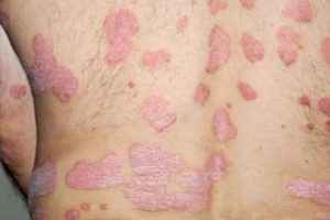 Candidiasis of Skin and Nails: Causes, Signs, Treatment and Prevention