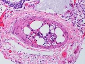 What Is the Survival Rate for Bone Marrow Cancer? - IYTmed.com