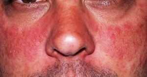 Systemic Lupus Erythematosus: Causes, Signs and Treatment