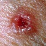 What Is Most Dangerous Type of Skin Cancer?