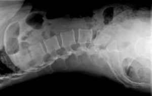 Bone Spurs in Neck: Causes, Symptoms and Treatment