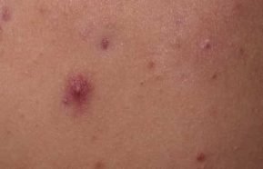Pimple on My Stomach: Causes and Treatment