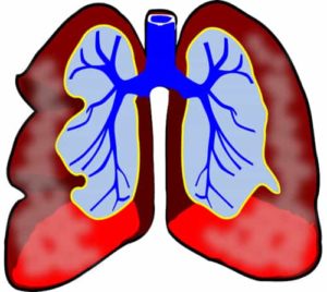 Blood Clots In Lung Causes Symptoms And Treatment Options