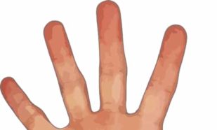 Causes of Itching Between Fingers (With and Without Rash)