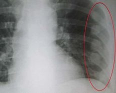 What Does a Broken Rib Feel Like? - IYTmed.com