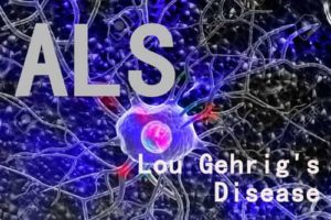 Life Expectancy for Lou Gehrig's Disease (ALS) | IYTmed.com