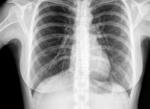 Causes of Pain Under Right Rib and Breast | IYTmed.com