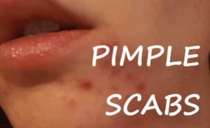 How to Get Rid of Pimple Scabs - IYTmed.com
