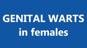 Genital Warts in Women: Causes, Symptoms, Treatment and Prevention