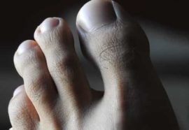 Wart Between Toes: Symptoms, Causes and Remedies | IYTmed.com