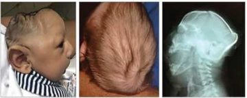 Life Expectancy of Microcephaly - IYTmed.com