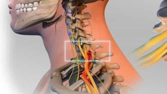 Treatments for Bulging Disks in Neck - IYTmed.com