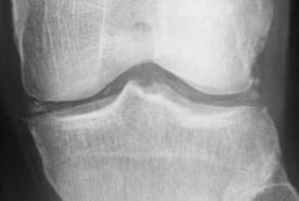 Symptoms and Causes of Pseudogout and How to Treat It - IYTmed.com
